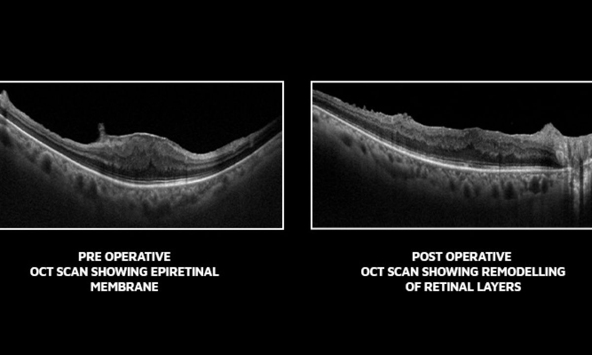 Epiretinal Membrane (ERM) - Dr-Mohit-Jain